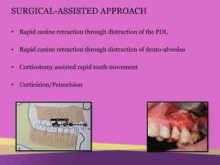 Accelerated orthodontic tooth movement | PPTX