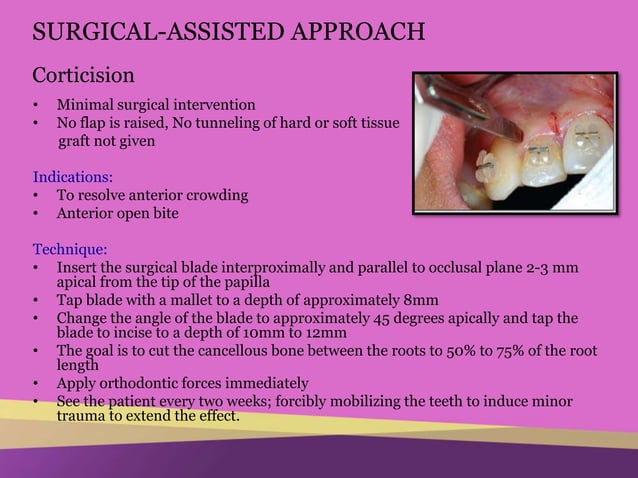 Accelerated orthodontic tooth movement | PPT