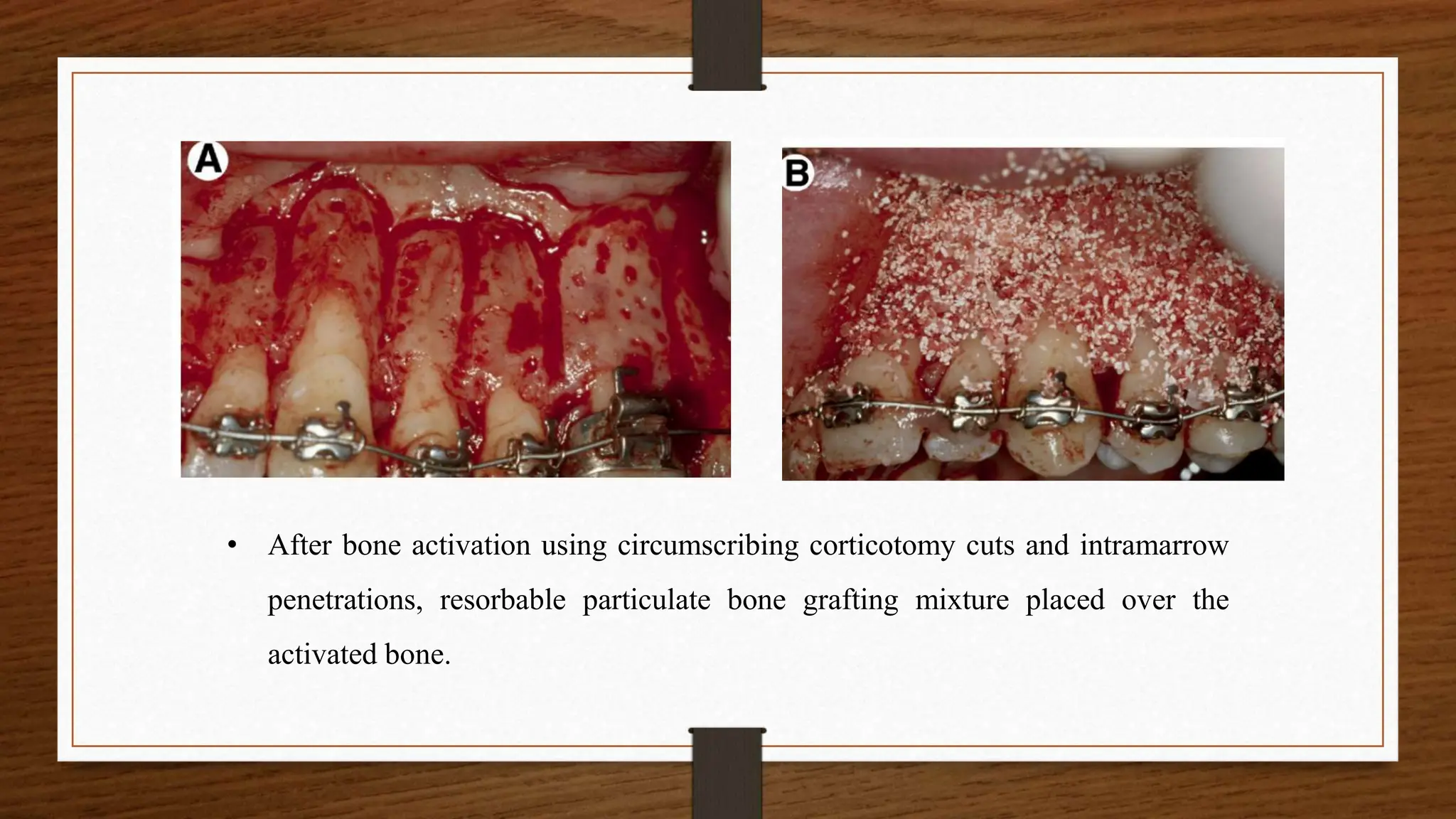 Accelerated Osteogenic Orthodontics Technique.pptx