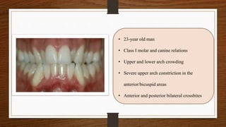 Accelerated Osteogenic Orthodontics Technique.pptx