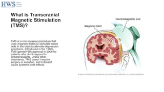 Accelerated TMS Moving Quickly into the Future of Depression Treatment ...