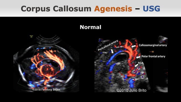 Agenesis of the Corpus Callosum | PDF | Pregnancy | Reproductive Health