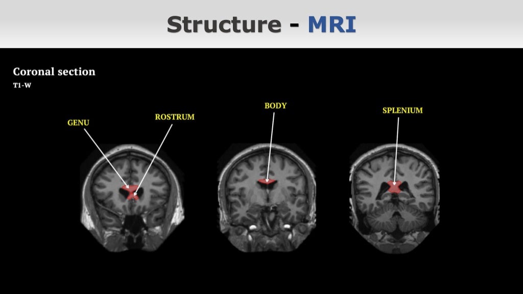 Agenesis of the Corpus Callosum