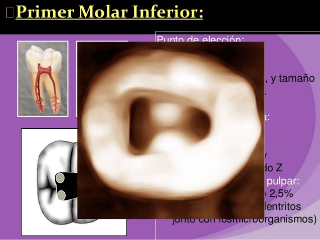 Acceso al conducto radicular en dientes inferiores