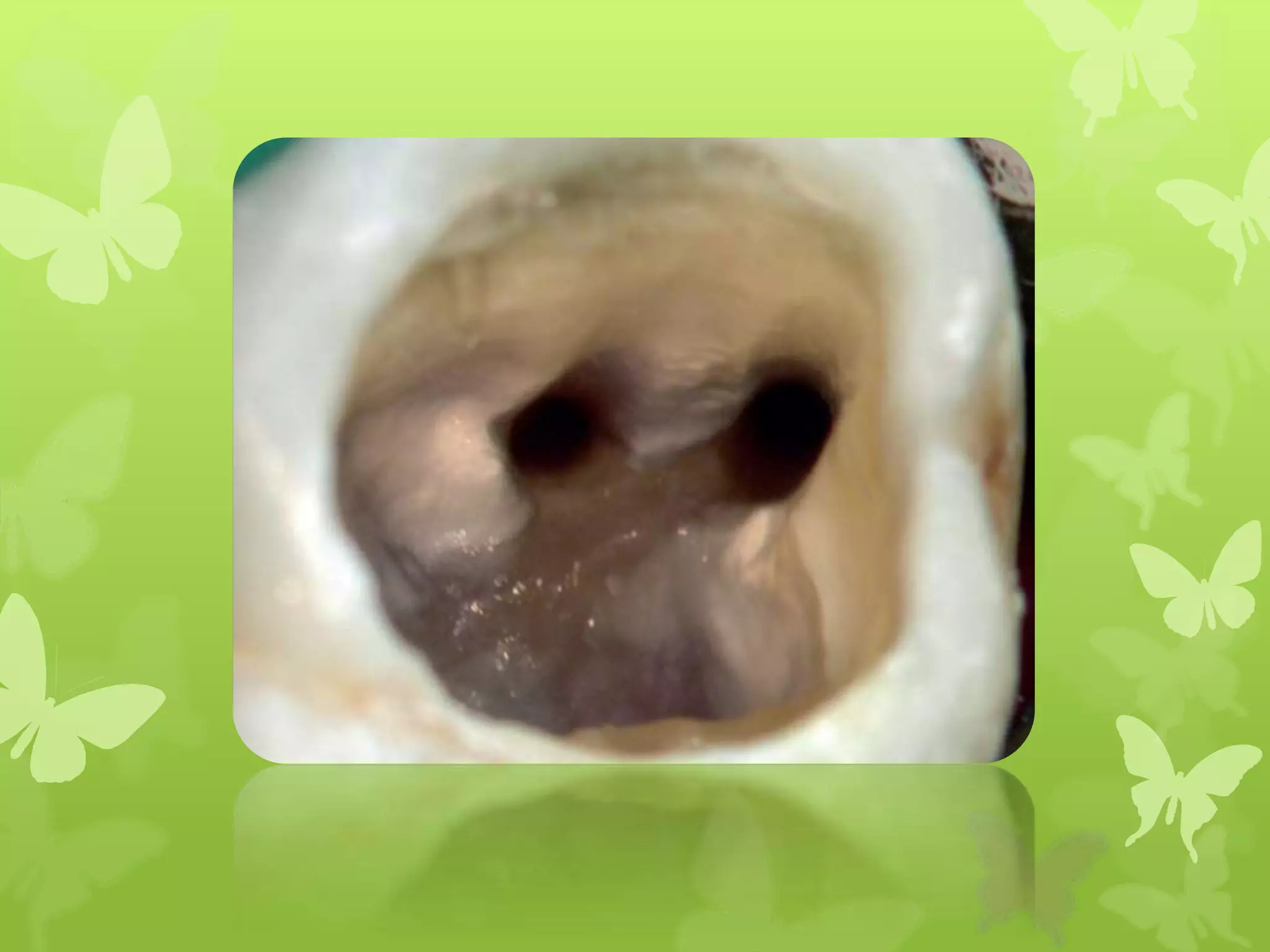 Acces opening of anterior and premolar teeth(shadan) | PPTX