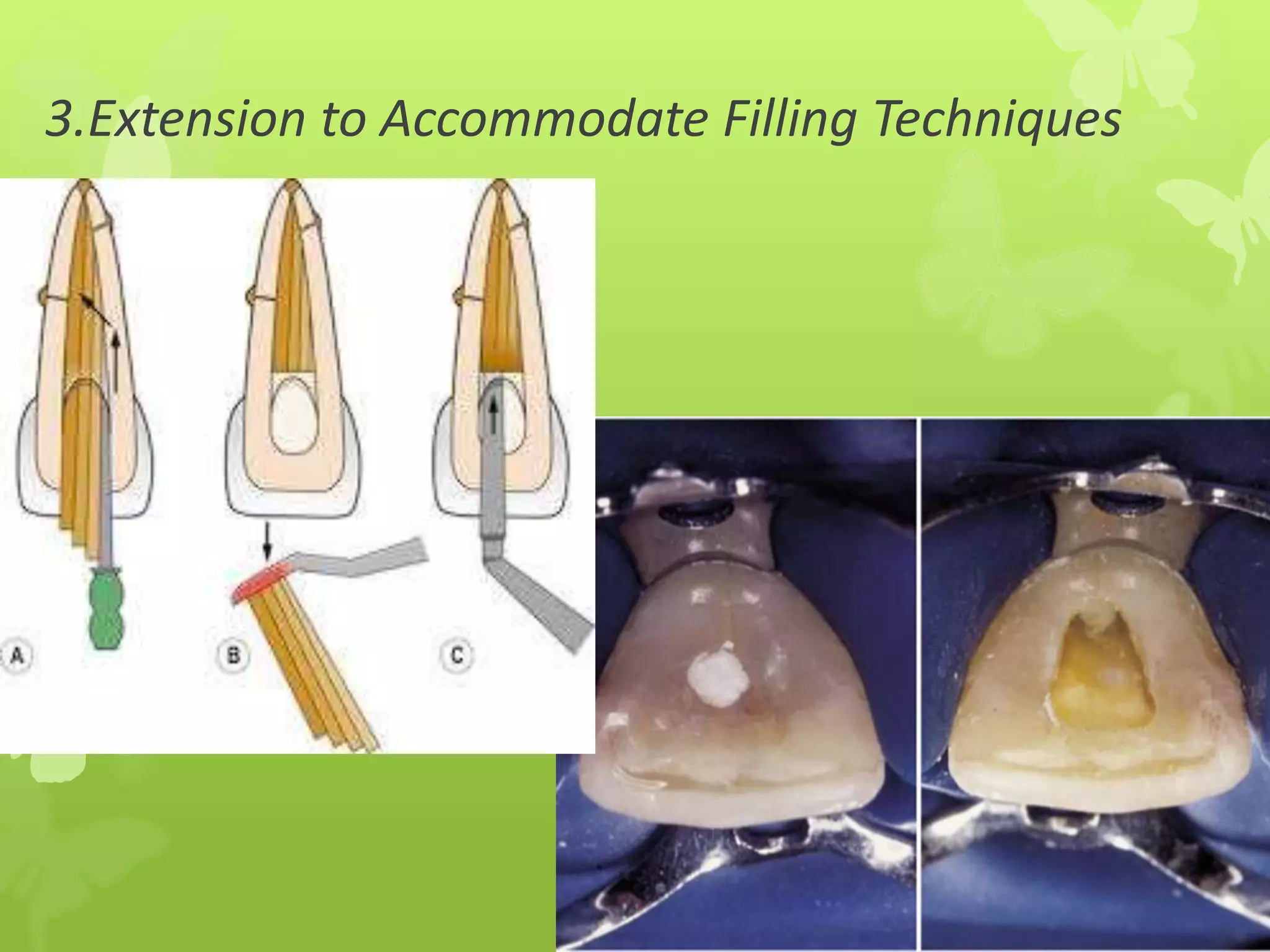 Acces opening of anterior and premolar teeth(shadan) | PPTX
