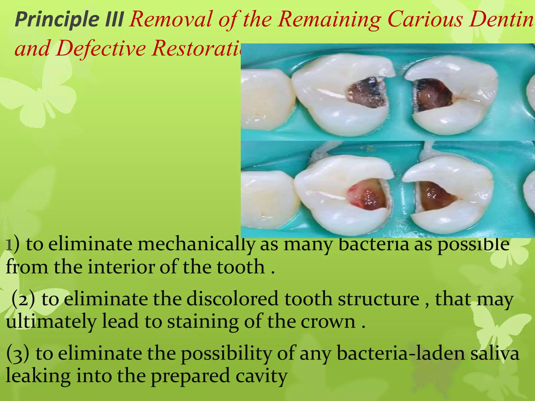 Acces opening of anterior and premolar teeth(shadan) | PPTX