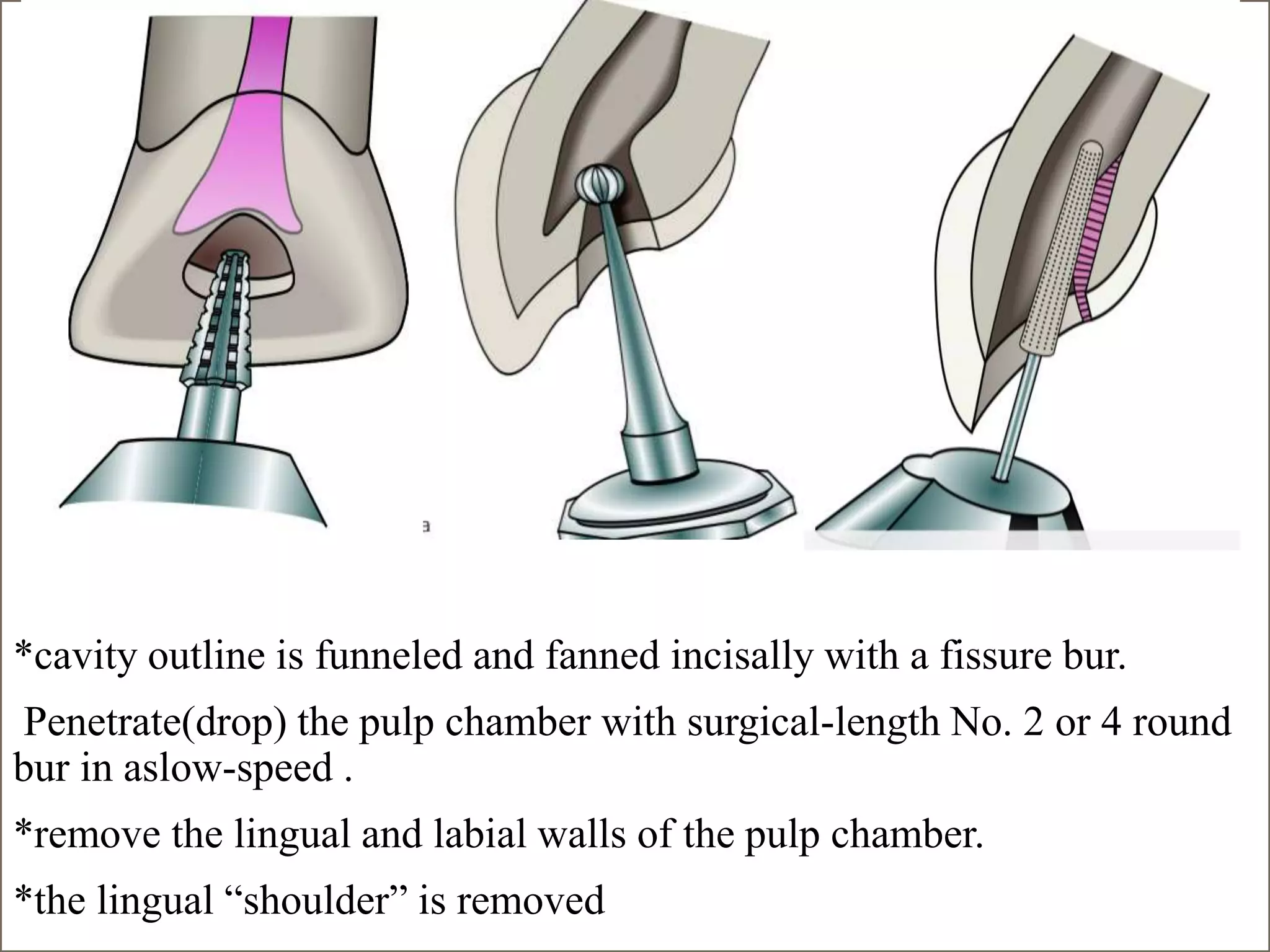 Acces opening of anterior and premolar teeth(shadan) | PPTX