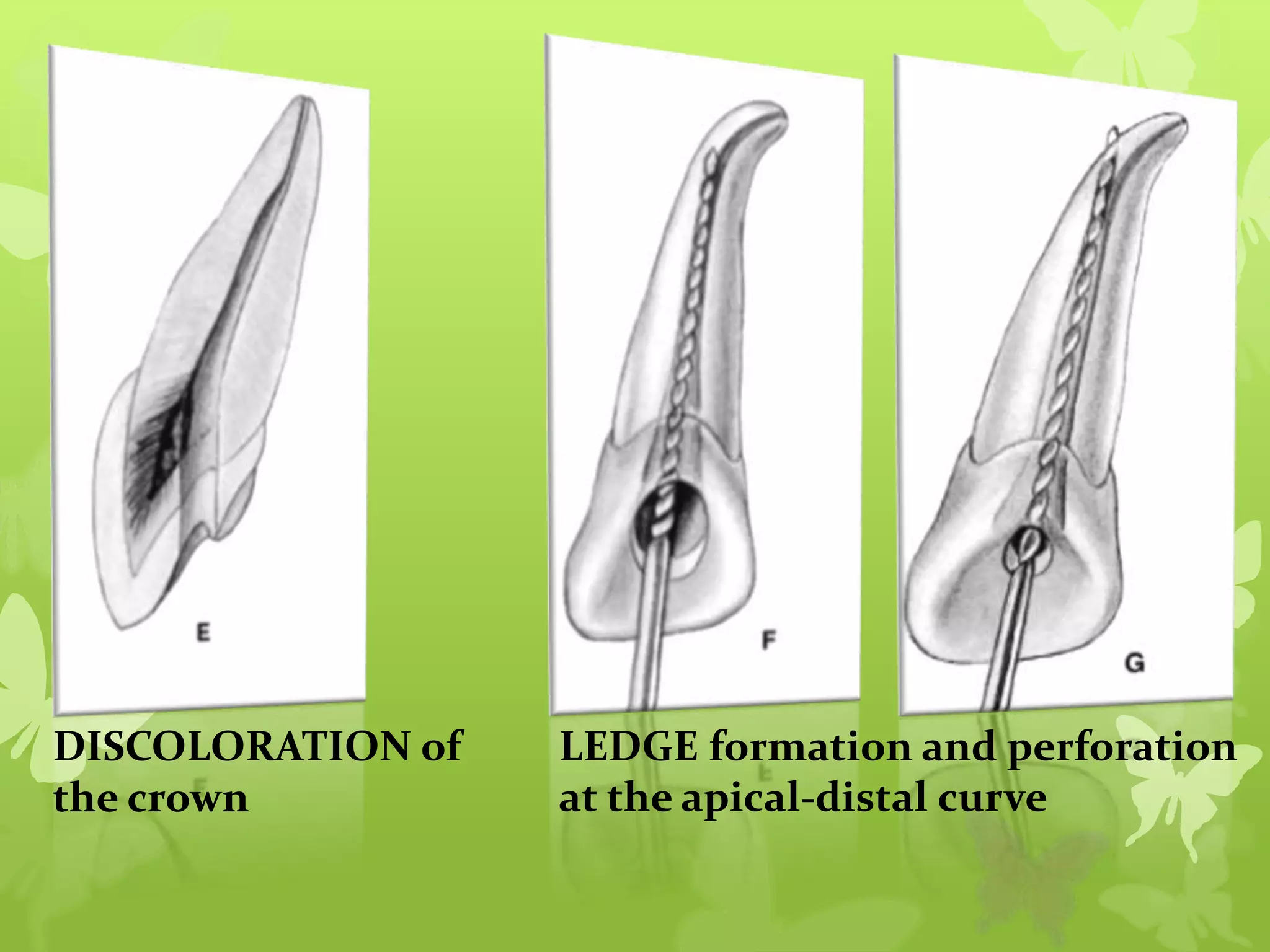 Acces opening of anterior and premolar teeth(shadan) | PPTX