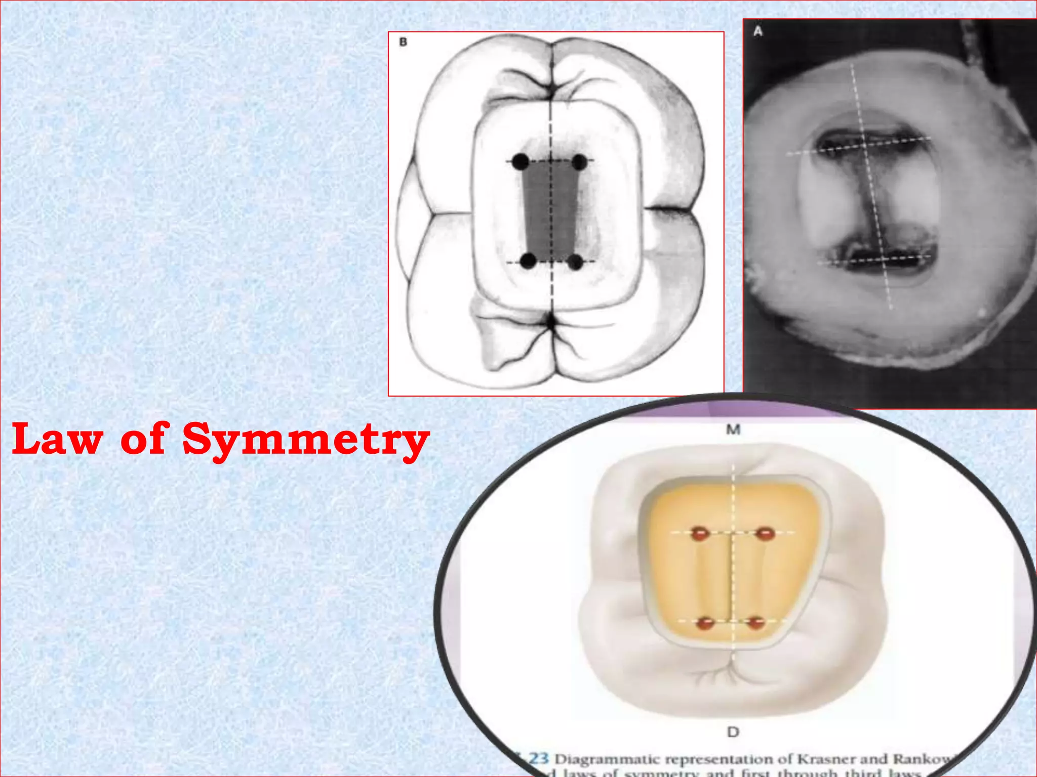Acces opening of anterior and premolar teeth(shadan) | PPTX