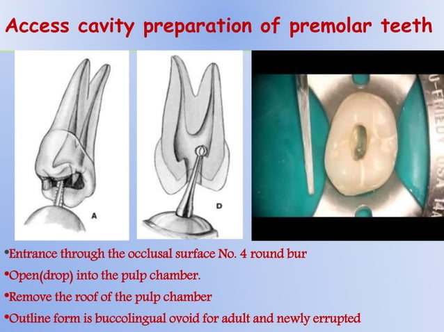 Acces opening of anterior and premolar teeth(shadan) | PPT