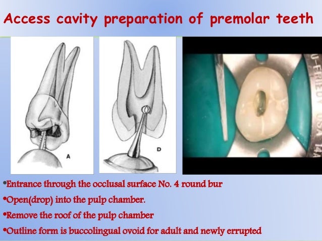 Acces opening of anterior and premolar teeth(shadan)