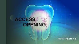 Access opening | PPTX