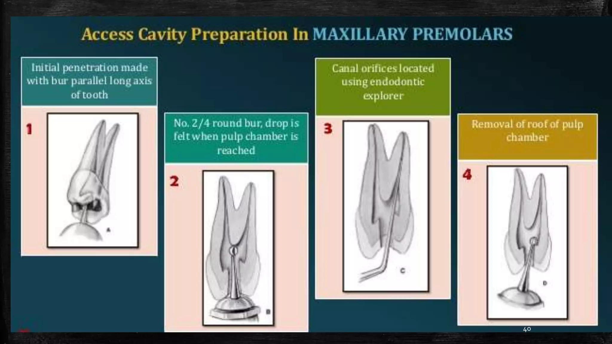 Access cavity prepration | PPTX