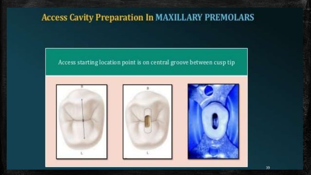 Access cavity prepration | PPTX | Dental Health | Diseases and Conditions