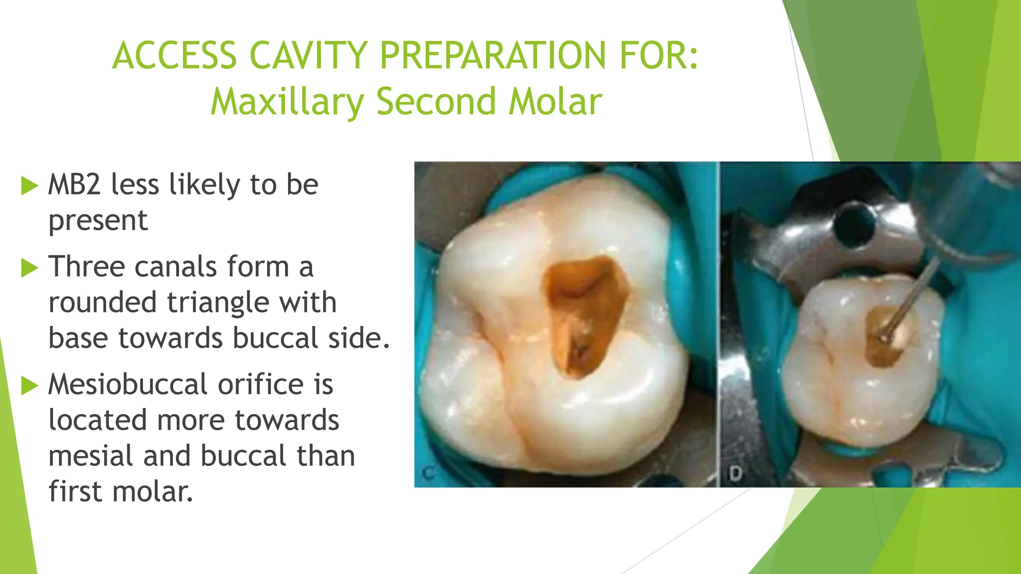 access cavity preparation in upper and lower teeth. pdf | PDF