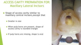 access cavity preparation in upper and lower teeth. pdf | PPT