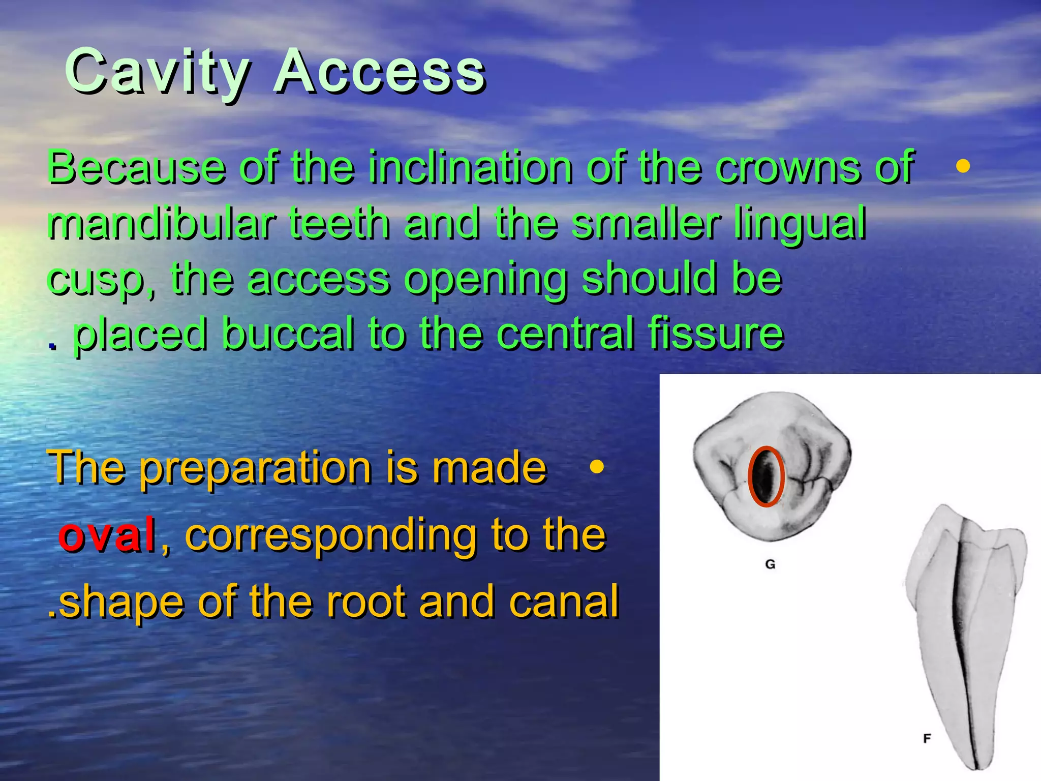 Access cavity preparation | PPT