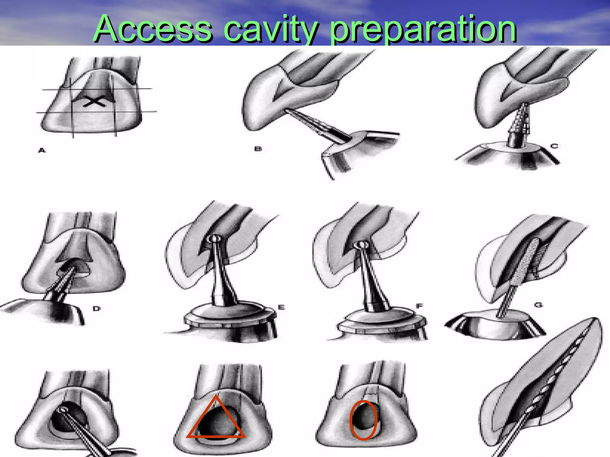 Access cavity preparation | PPT