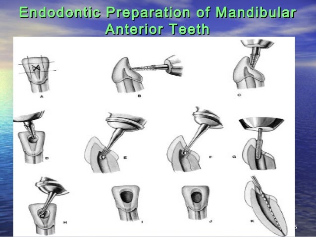 Access cavity preparation