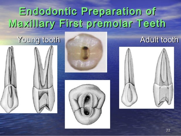 Access cavity preparation