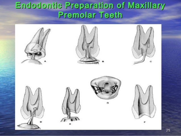 Mandibular First Premolar Endo