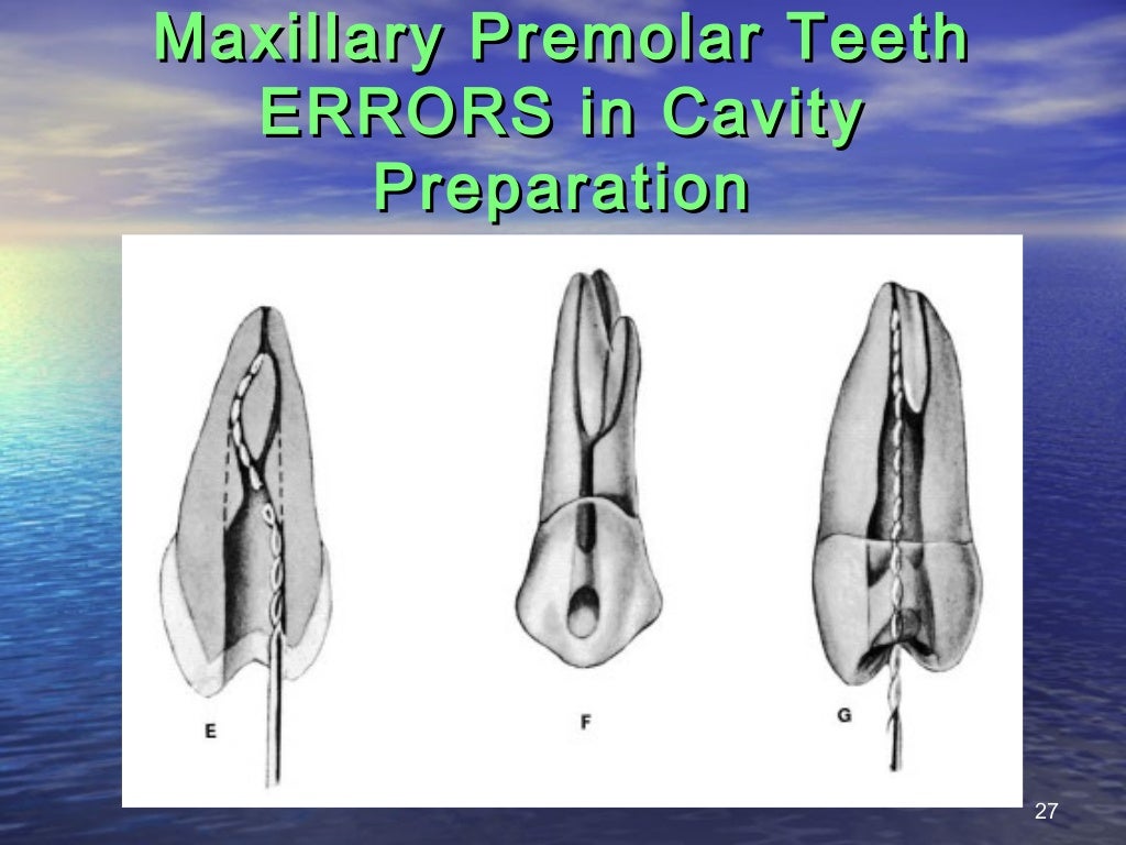 Access Cavity Preparation