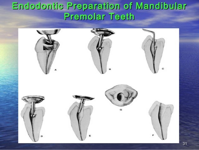 Access cavity preparation