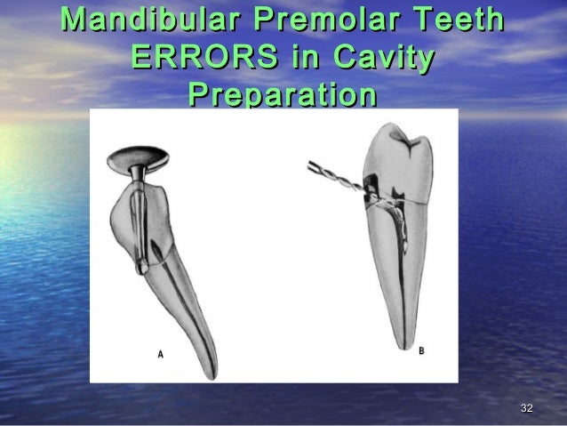 Access cavity preparation