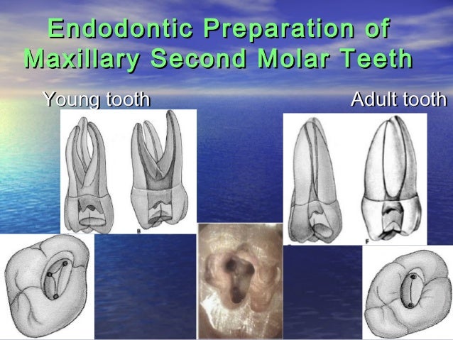 Access cavity preparation