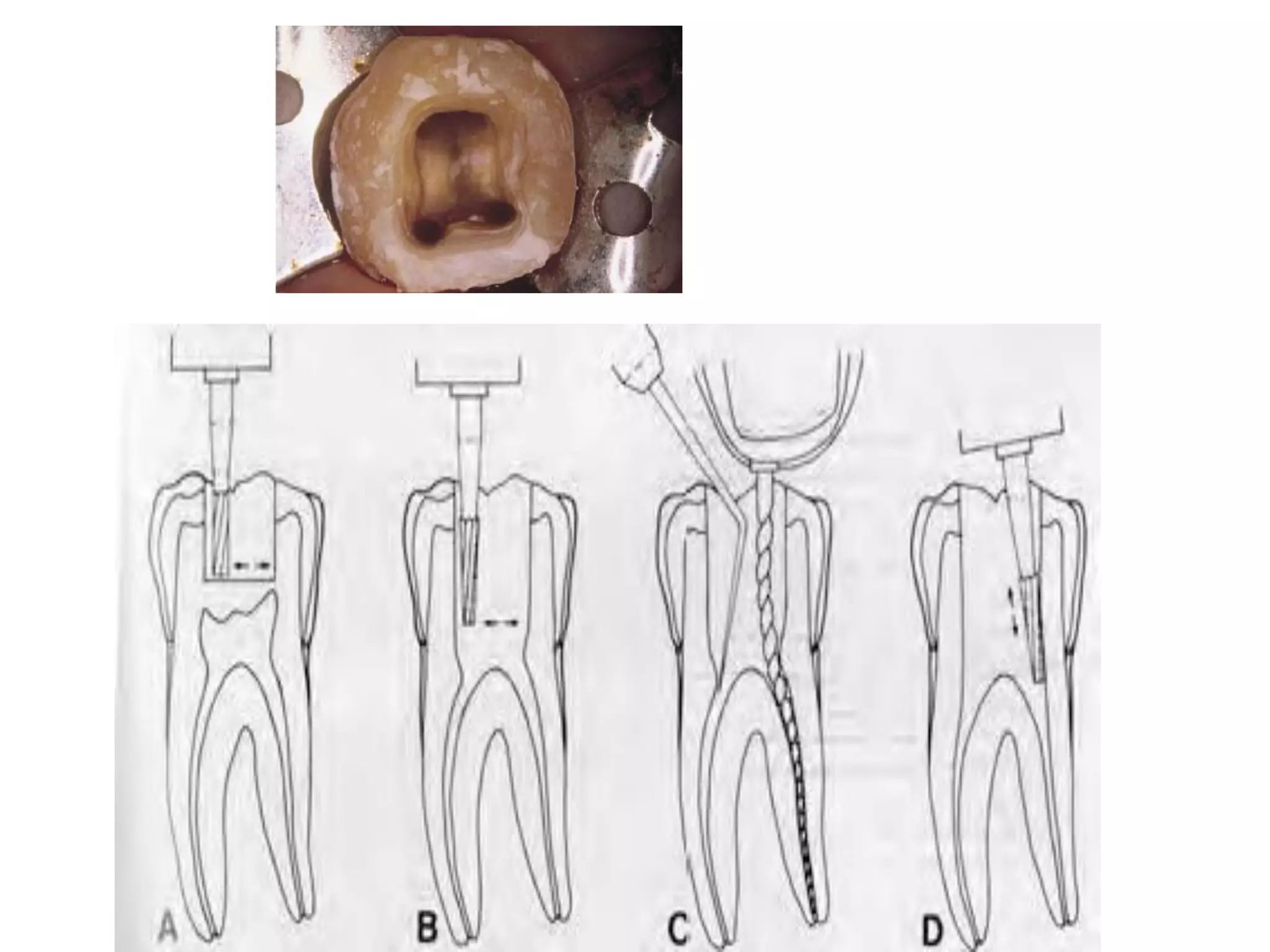 Access cavity preparation | PDF