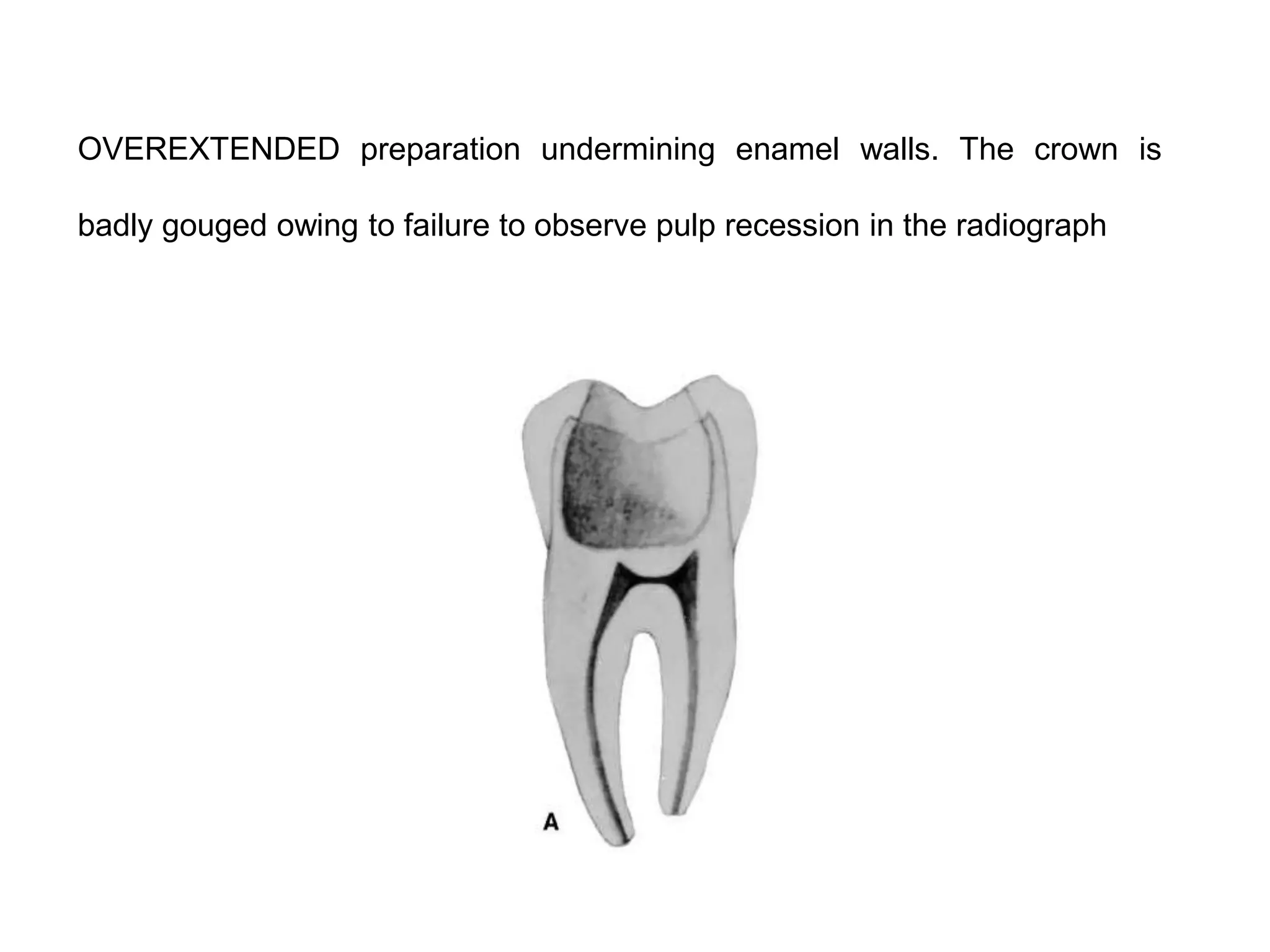 Access cavity preparation | PDF