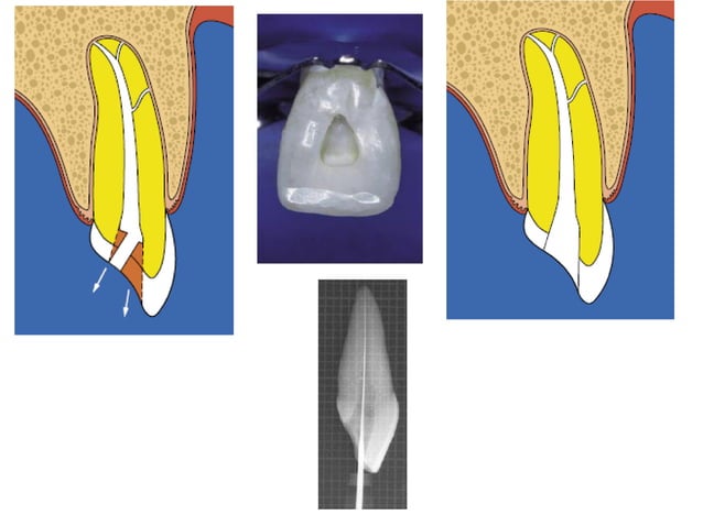 Access cavity preparation | PDF