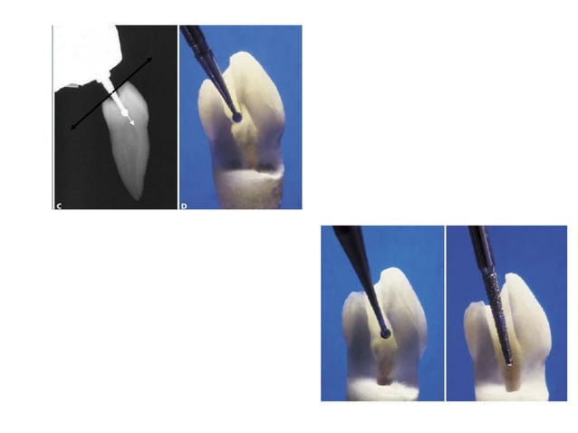 Access cavity preparation | PDF