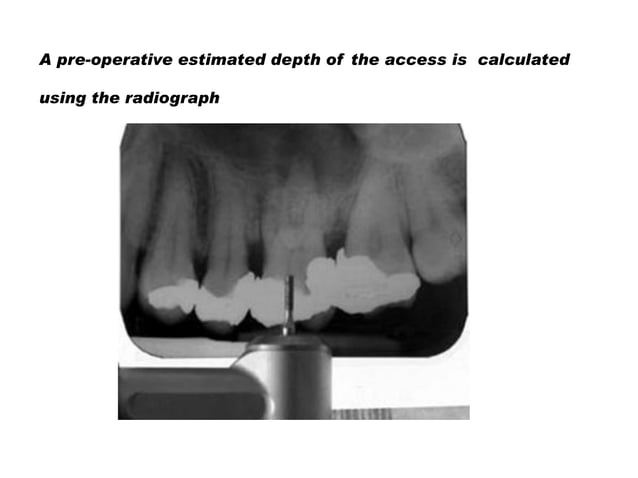 Access cavity preparation | PDF