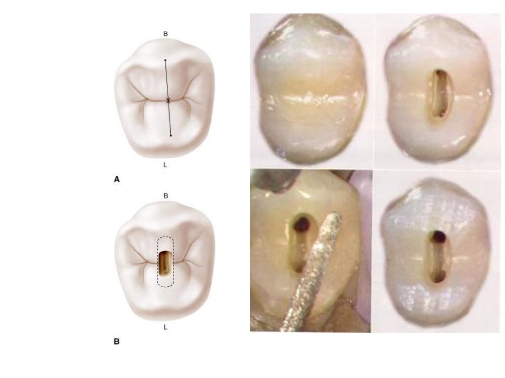 Access cavity preparation