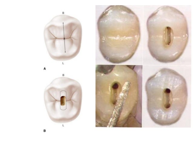 Access cavity preparation