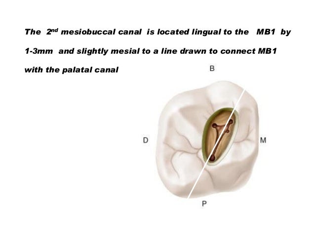 Access cavity preparation
