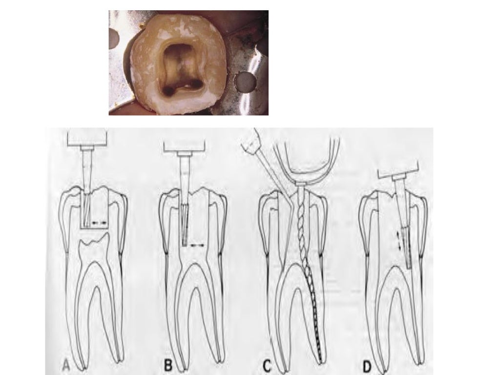 Access cavity preparation