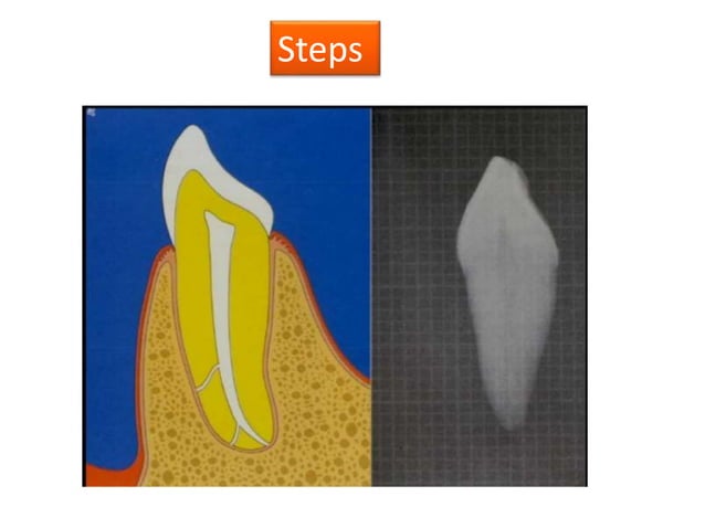 Access cavity preparation | PPTX