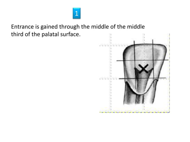 Access cavity preparation | PPTX