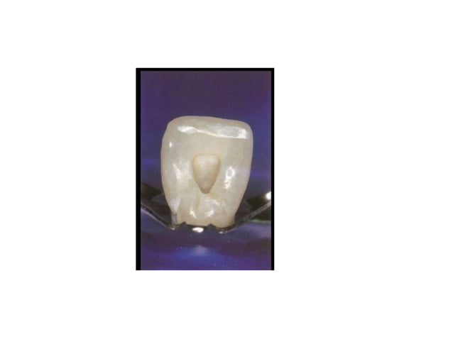 Access cavity preparation | PPTX