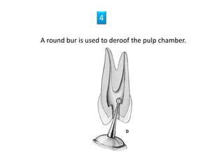 Access cavity preparation | PPTX