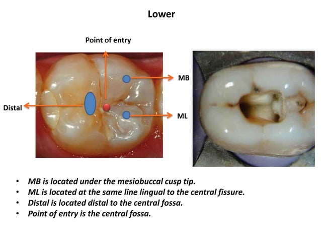 Access cavity preparation | PPTX