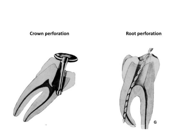 Access cavity preparation | PPTX