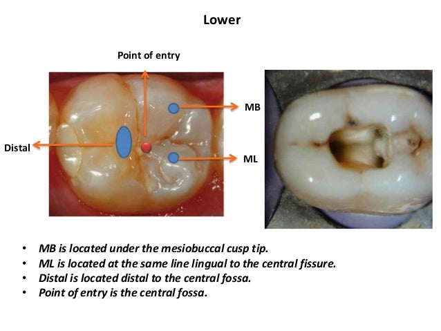 Access cavity preparation