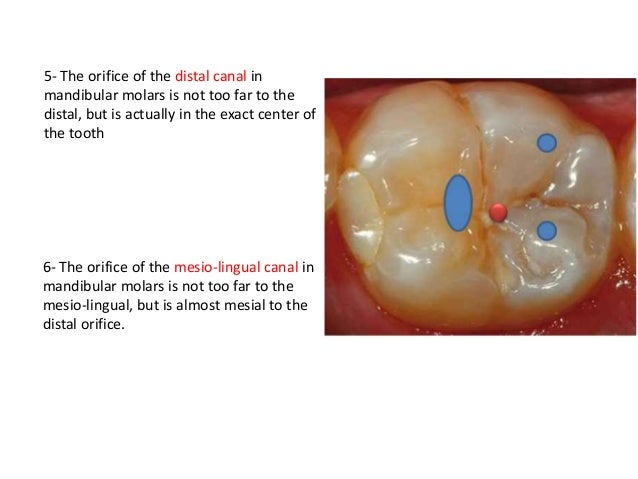 Access cavity preparation