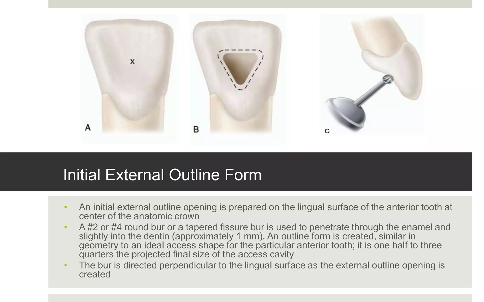 Access cavity preparation | PPTX