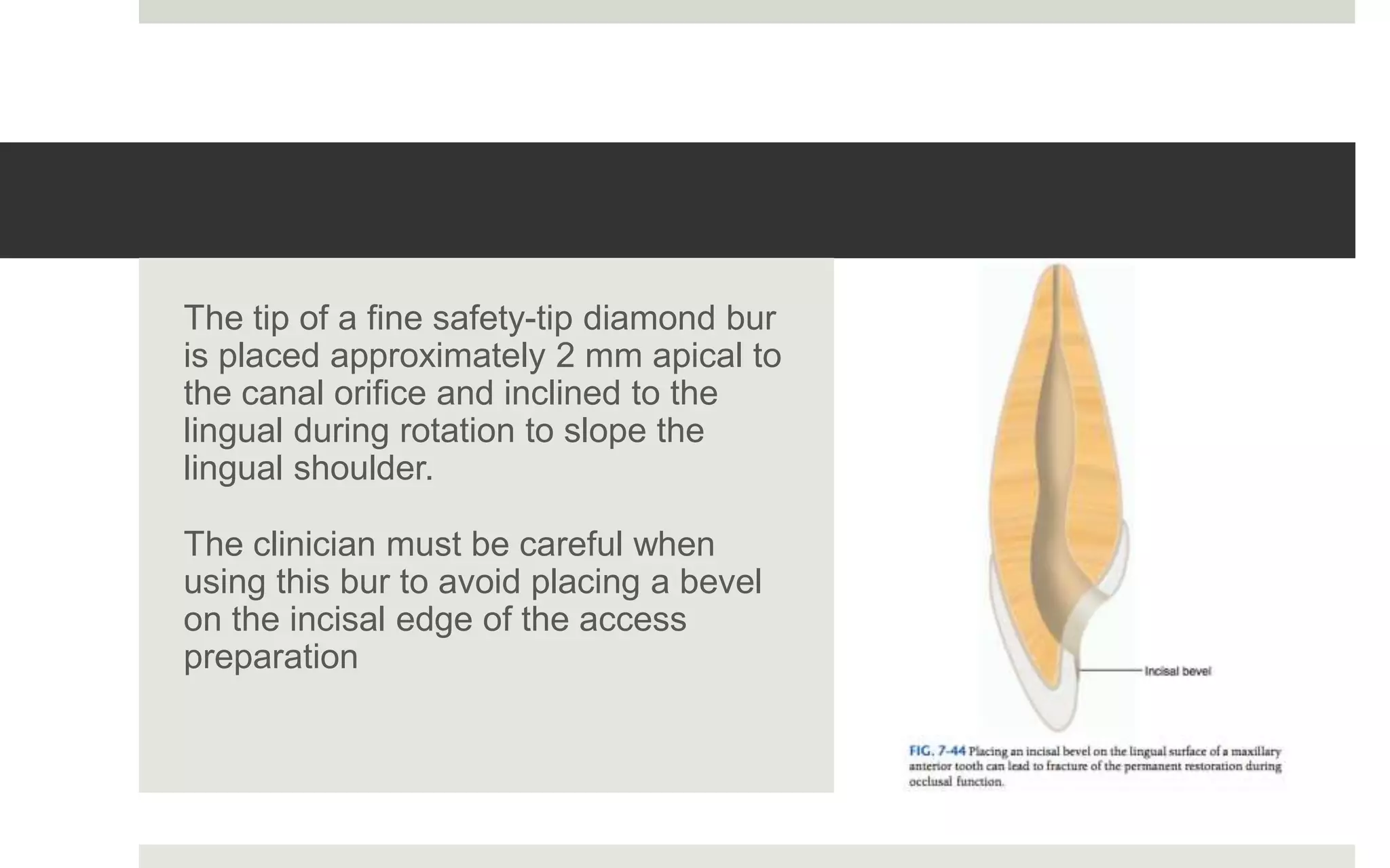 Access cavity preparation | PPTX