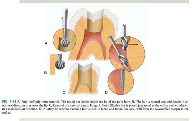 Access cavity preparation